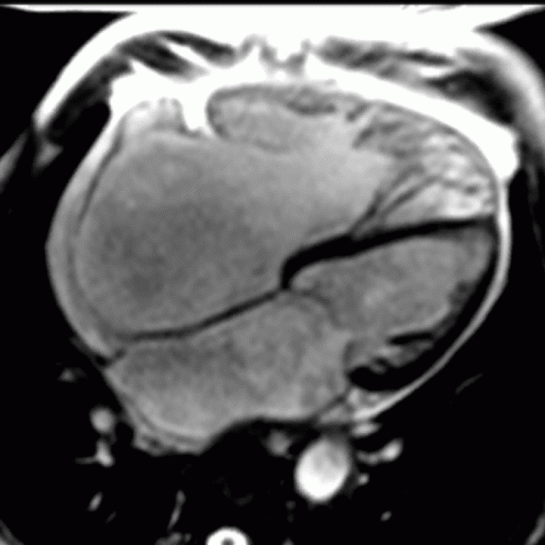 Open Heart Surgery – Medical GIF